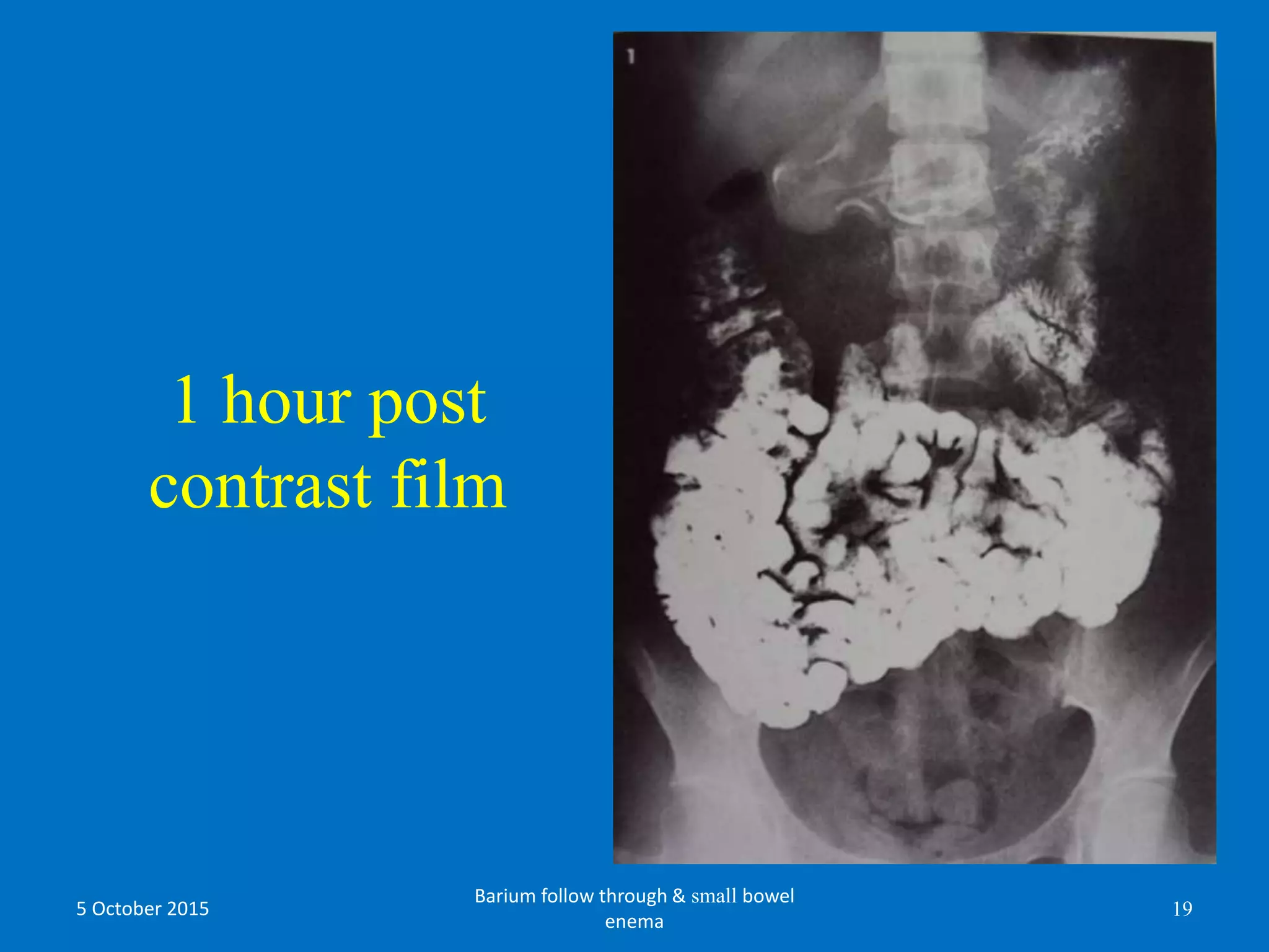 Barium follow through & small bowel enema ranju | PPTX