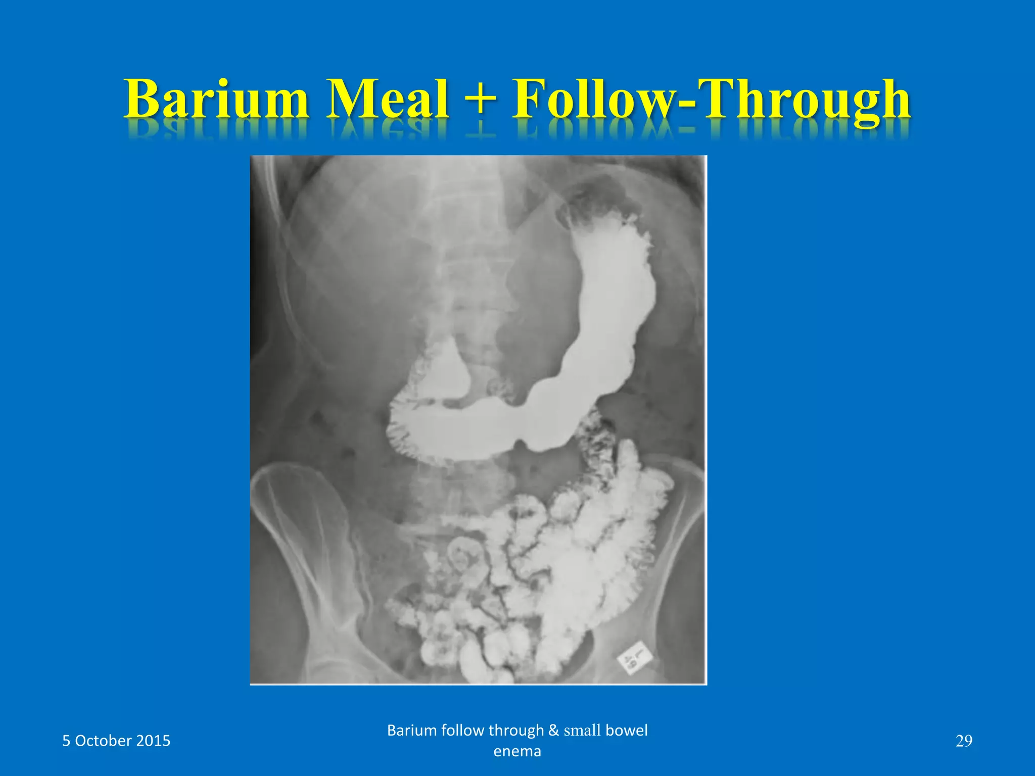 Barium follow through & small bowel enema ranju | PPTX