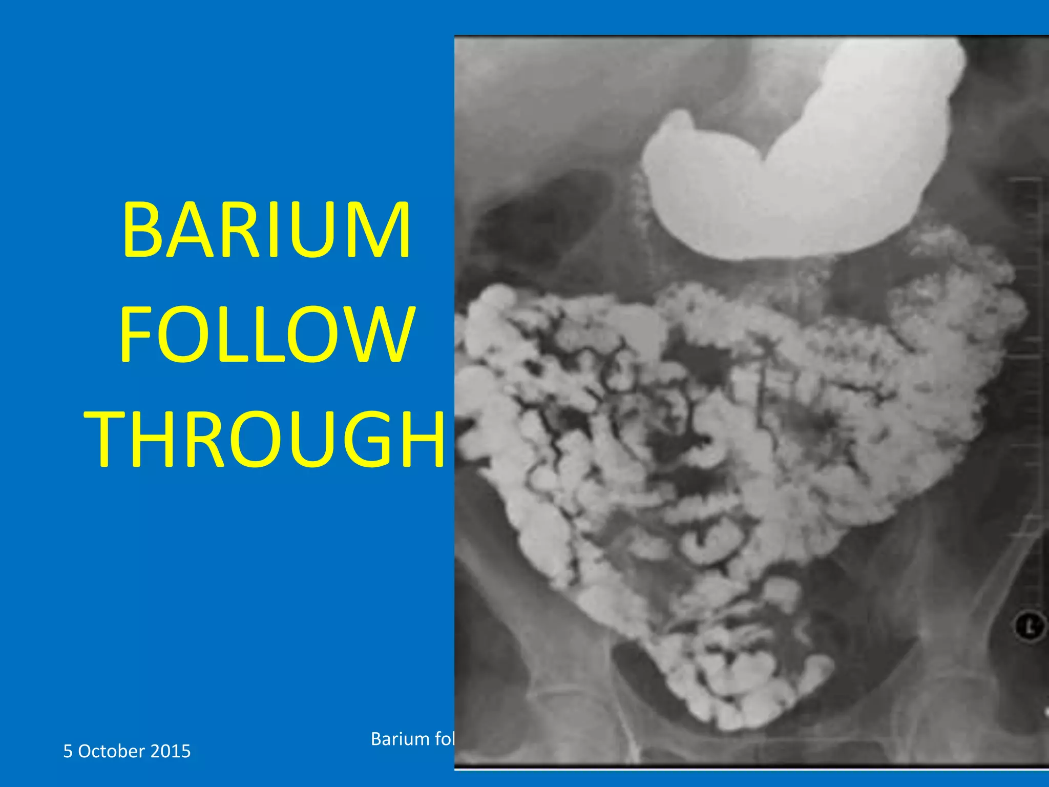 Barium follow through & small bowel enema ranju | PPTX