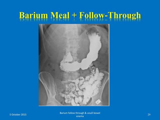 Barium follow through & small bowel enema ranju | PPTX