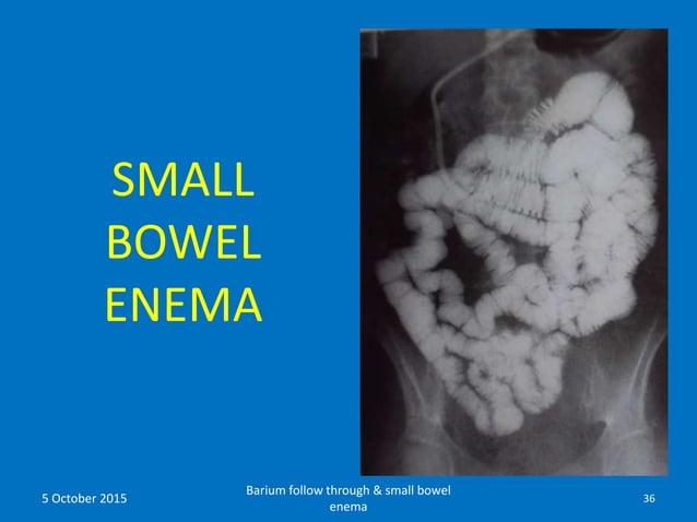 Barium follow through & small bowel enema ranju | PPTX