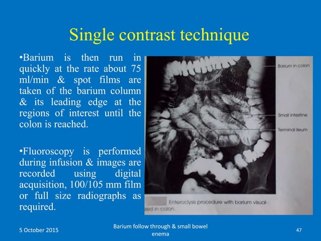 Barium follow through & small bowel enema ranju | PPTX