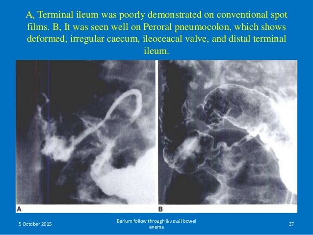 Barium follow through & small bowel enema ranju