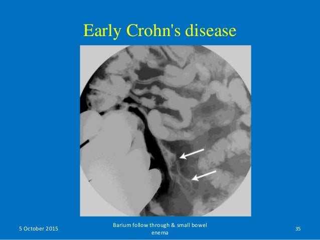 Barium follow through & small bowel enema ranju