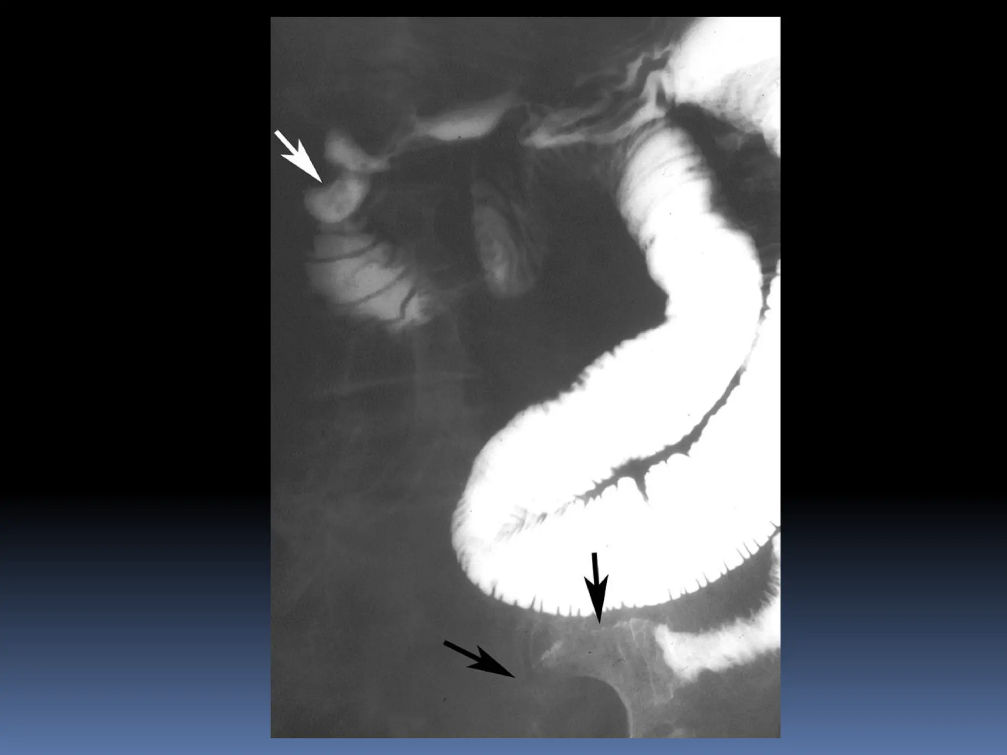 BARIUM IMAGING IN SMALL BOWEL ILEUM.pptx