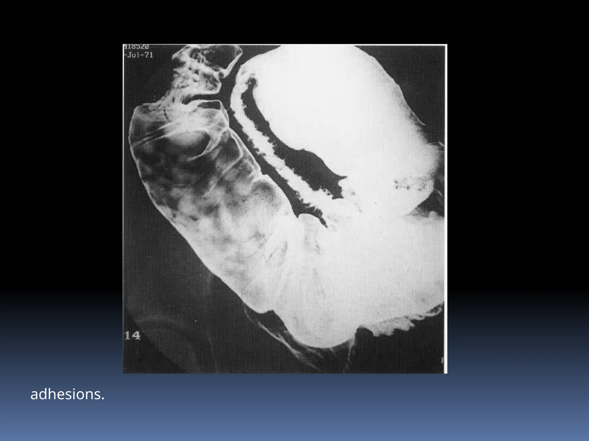 BARIUM IMAGING IN SMALL BOWEL ILEUM.pptx