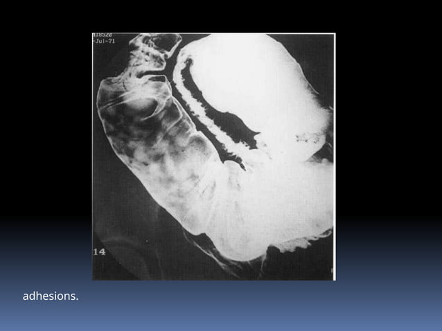 BARIUM IMAGING IN SMALL BOWEL ILEUM.pptx