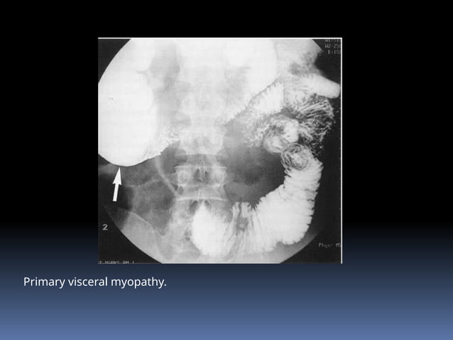 BARIUM IMAGING IN SMALL BOWEL ILEUM.pptx