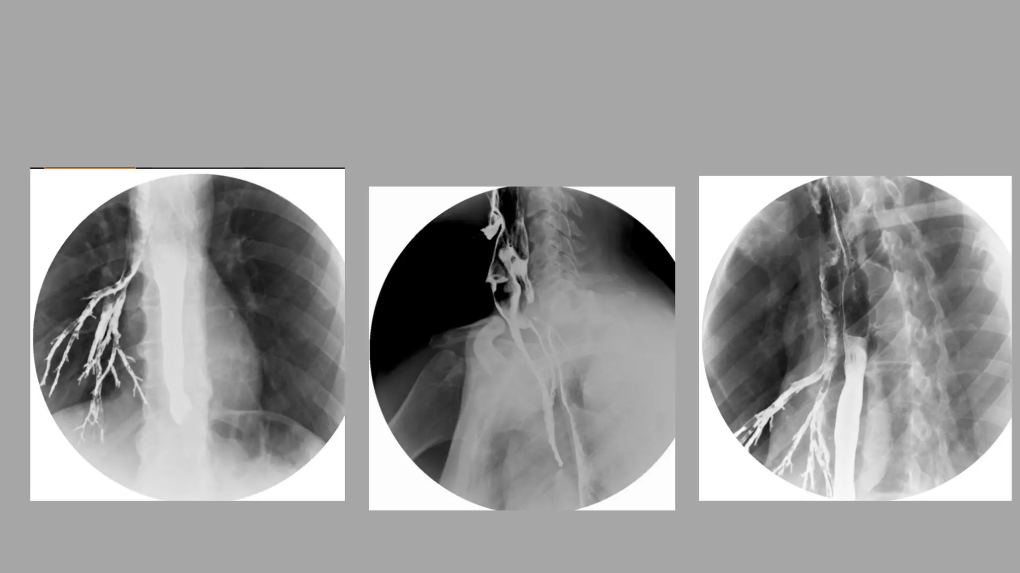 Larynx and barium follow through radiology.pptx