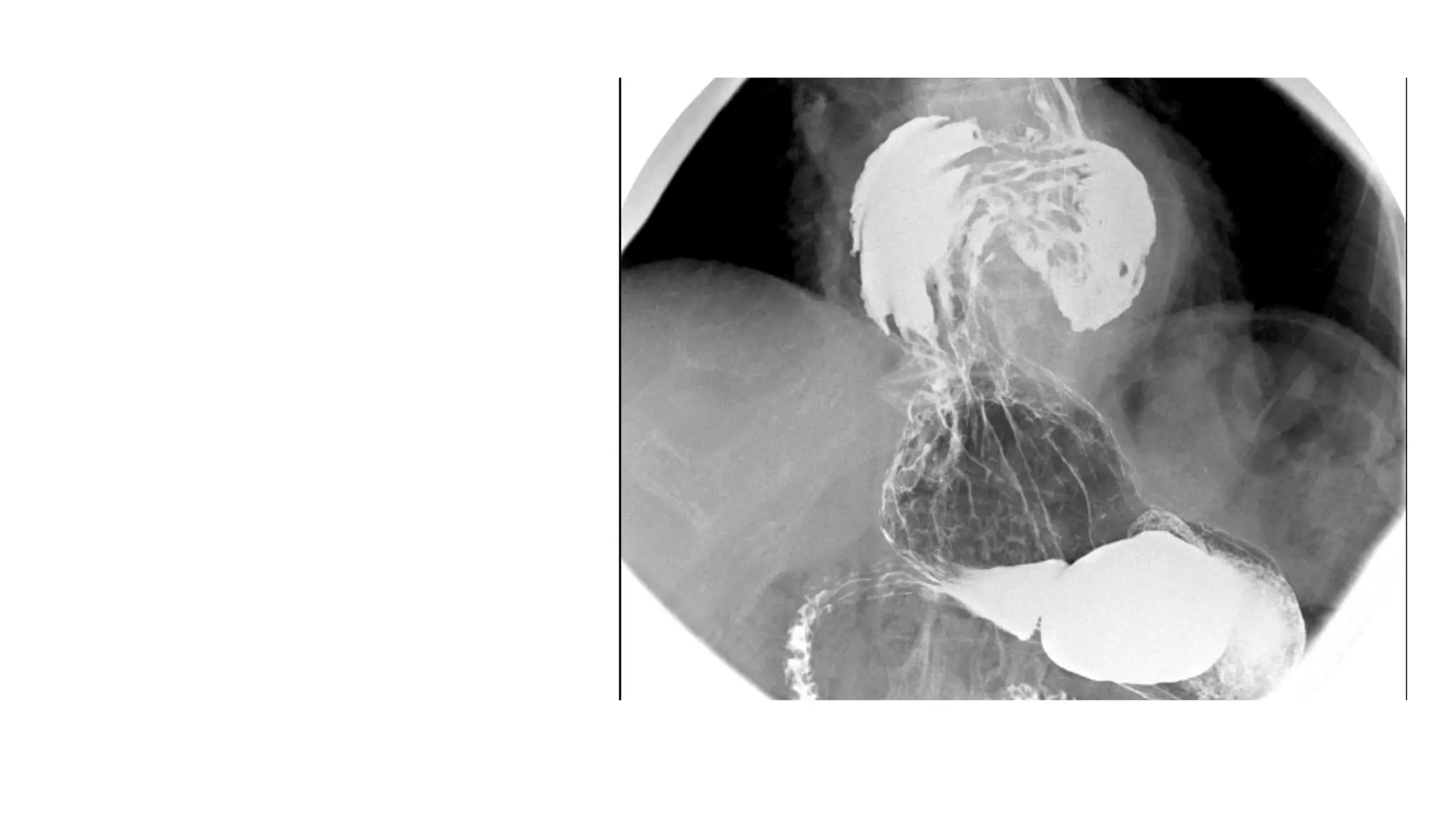 Larynx and barium follow through radiology.pptx