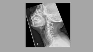 Larynx and barium follow through radiology.pptx