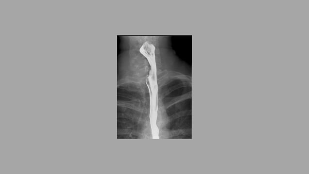 Larynx and barium follow through radiology.pptx