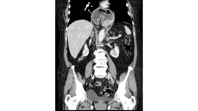 Larynx and barium follow through radiology.pptx