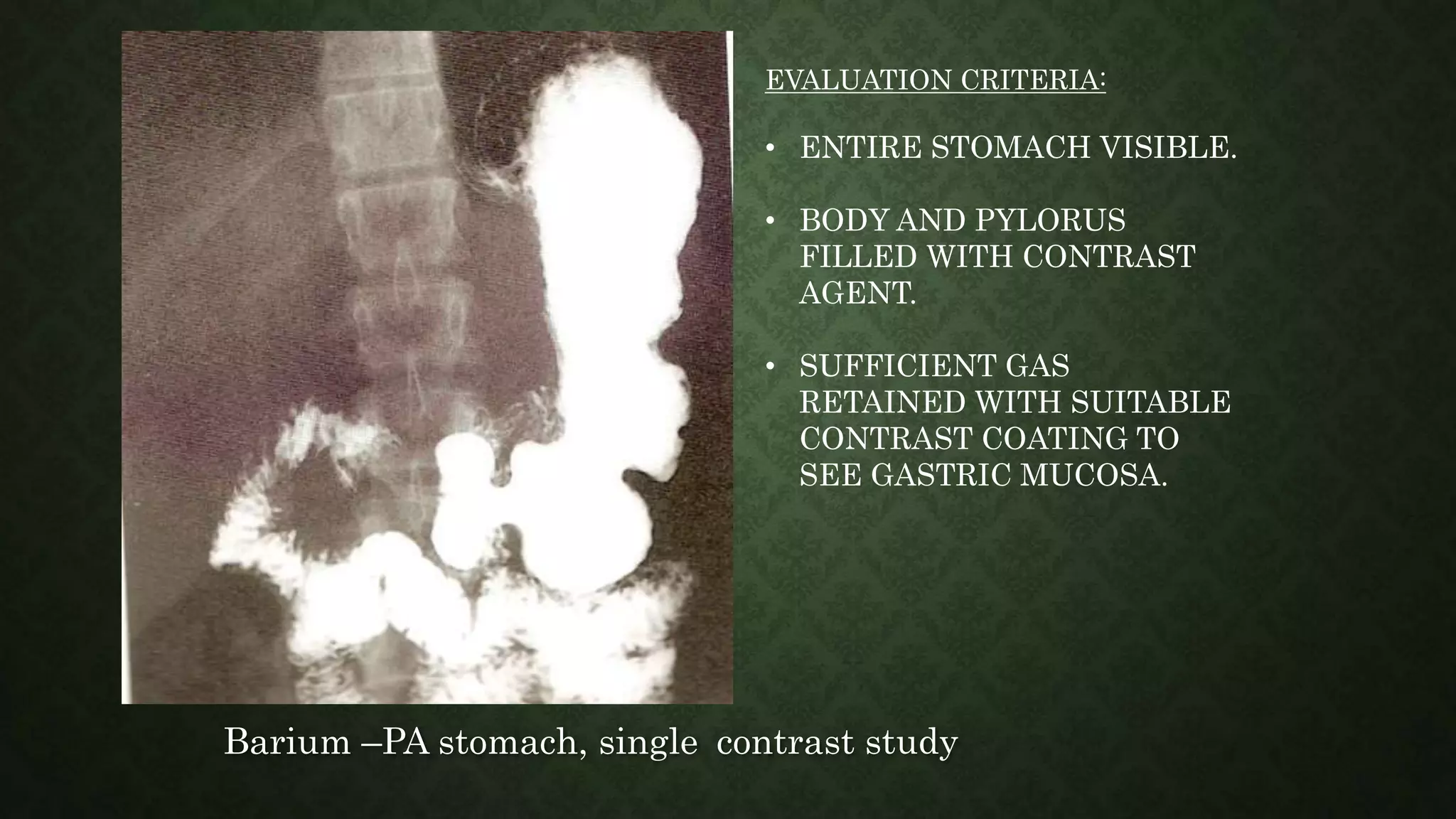 Barium meal | PPTX