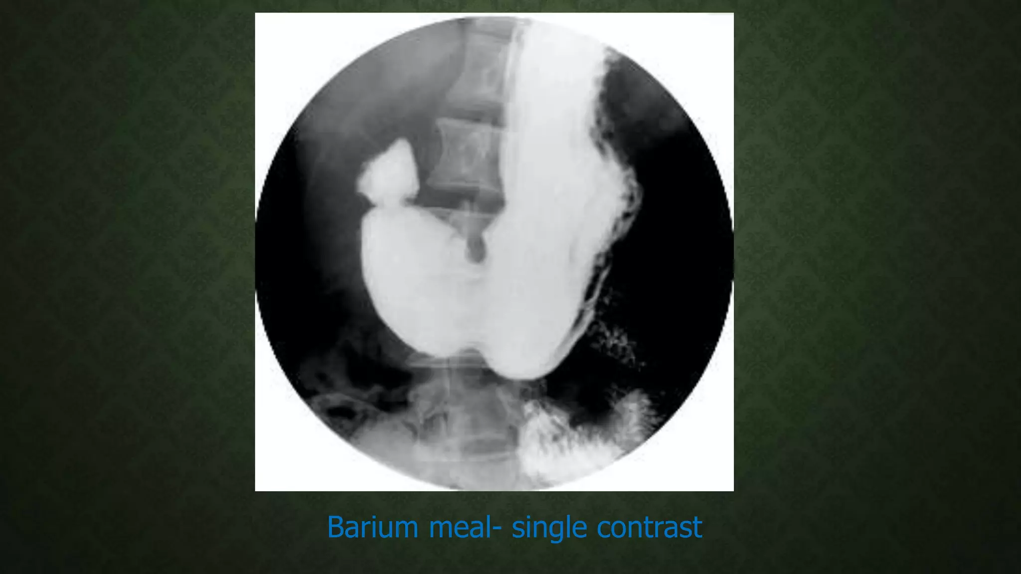 Barium meal | PPTX