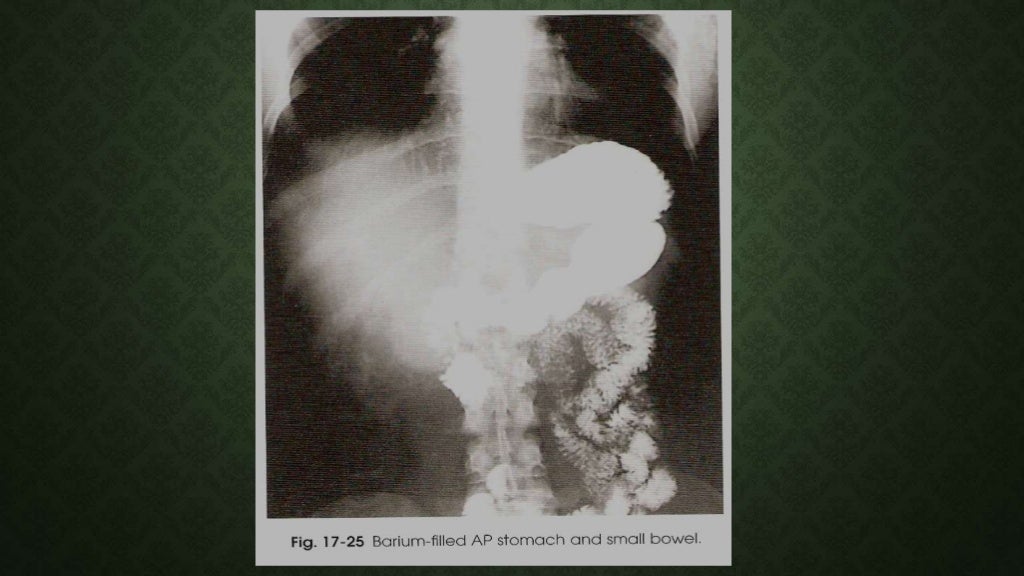 Barium Meal Barium Meal