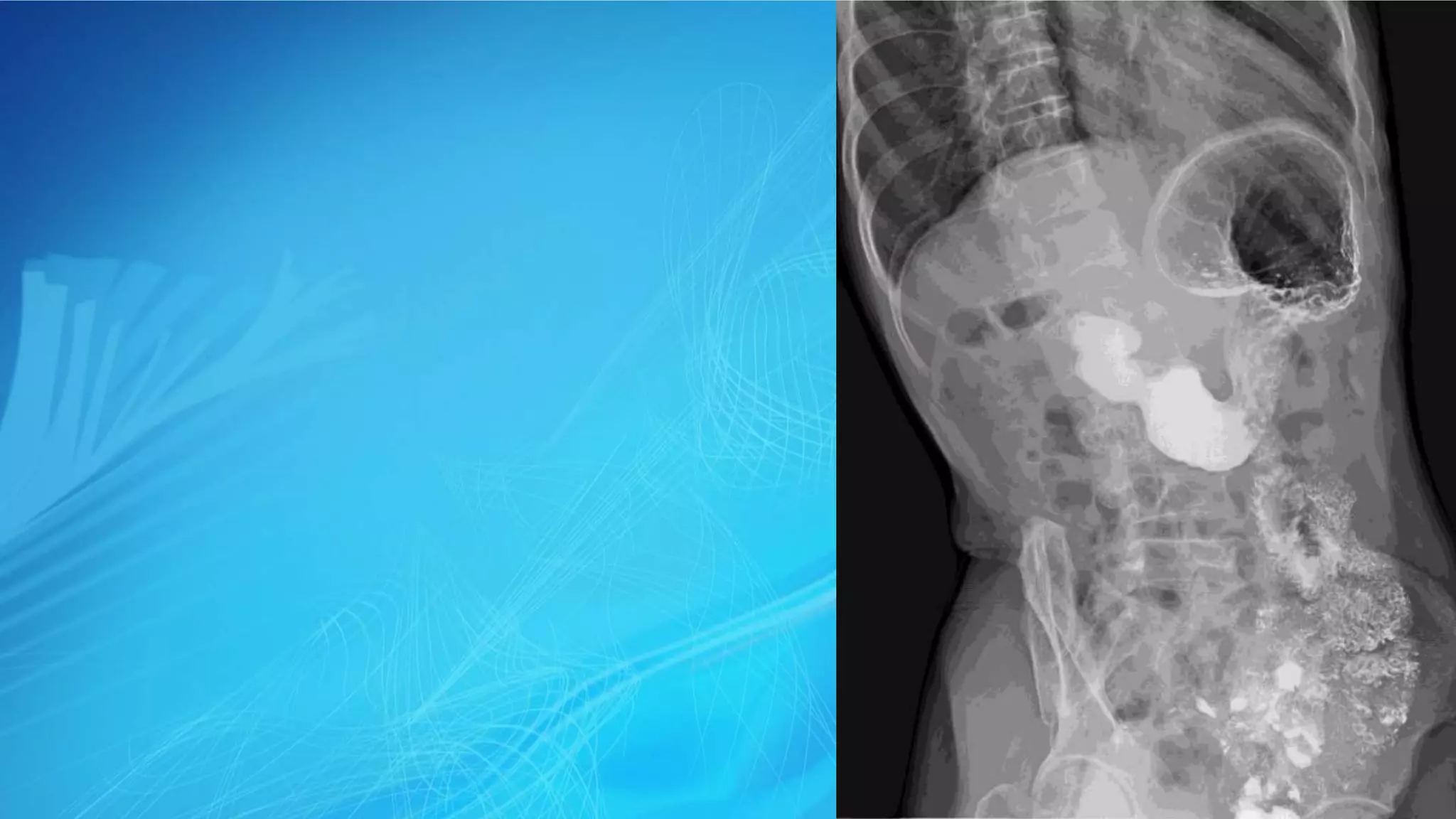 Barium Meal | PPTX
