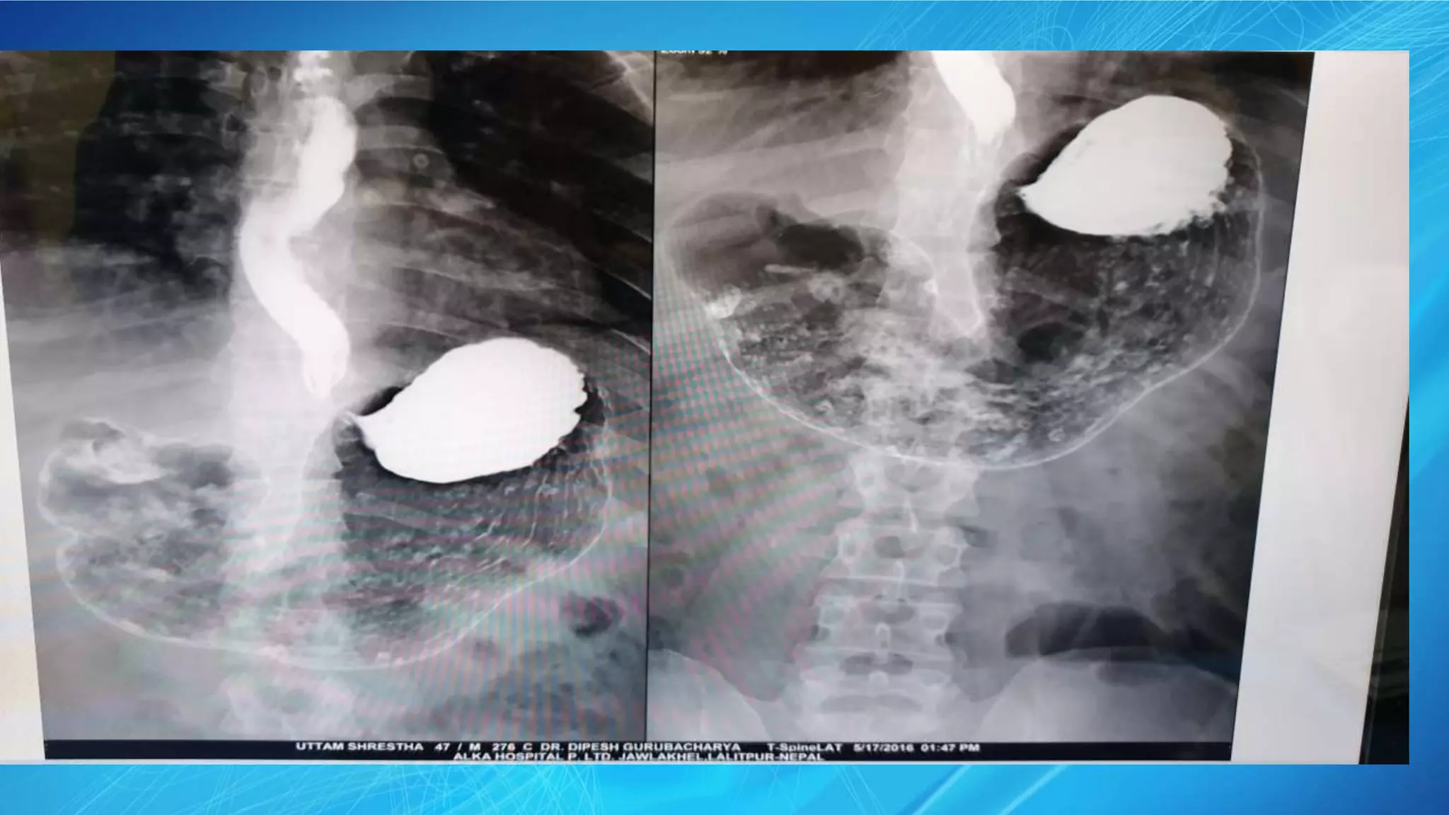Barium Meal | PPTX