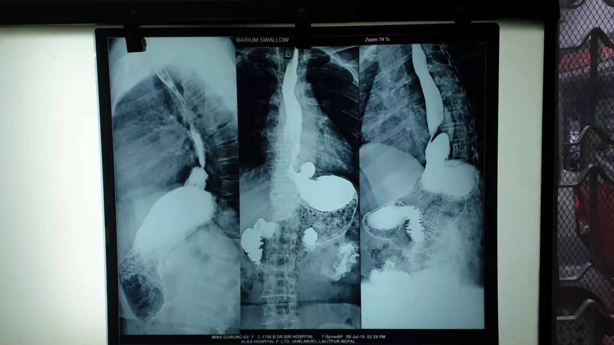 Barium Meal | PPTX