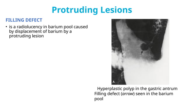 Barium meal. How to perform and interpret | PPT