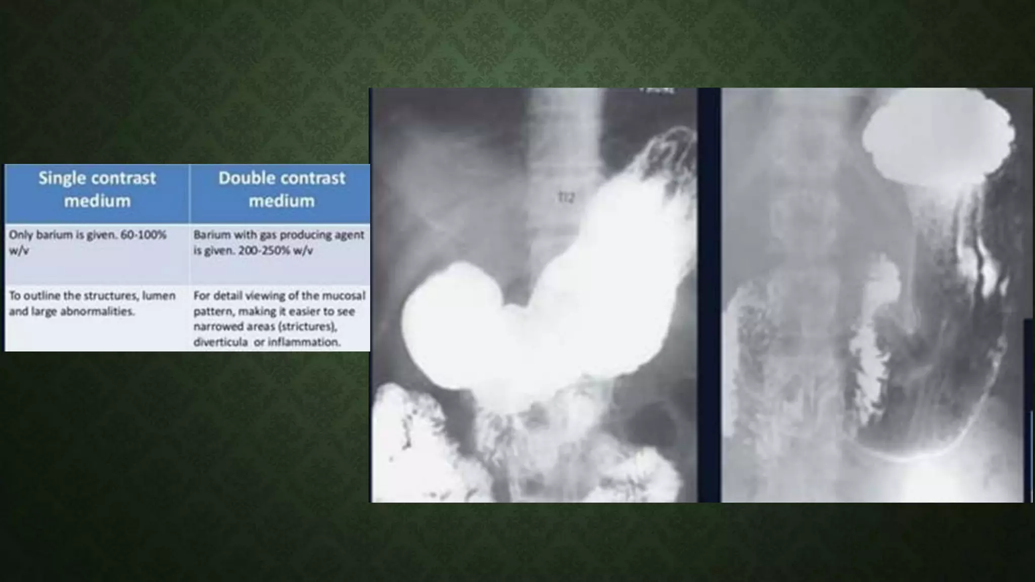 barium meal .pptx