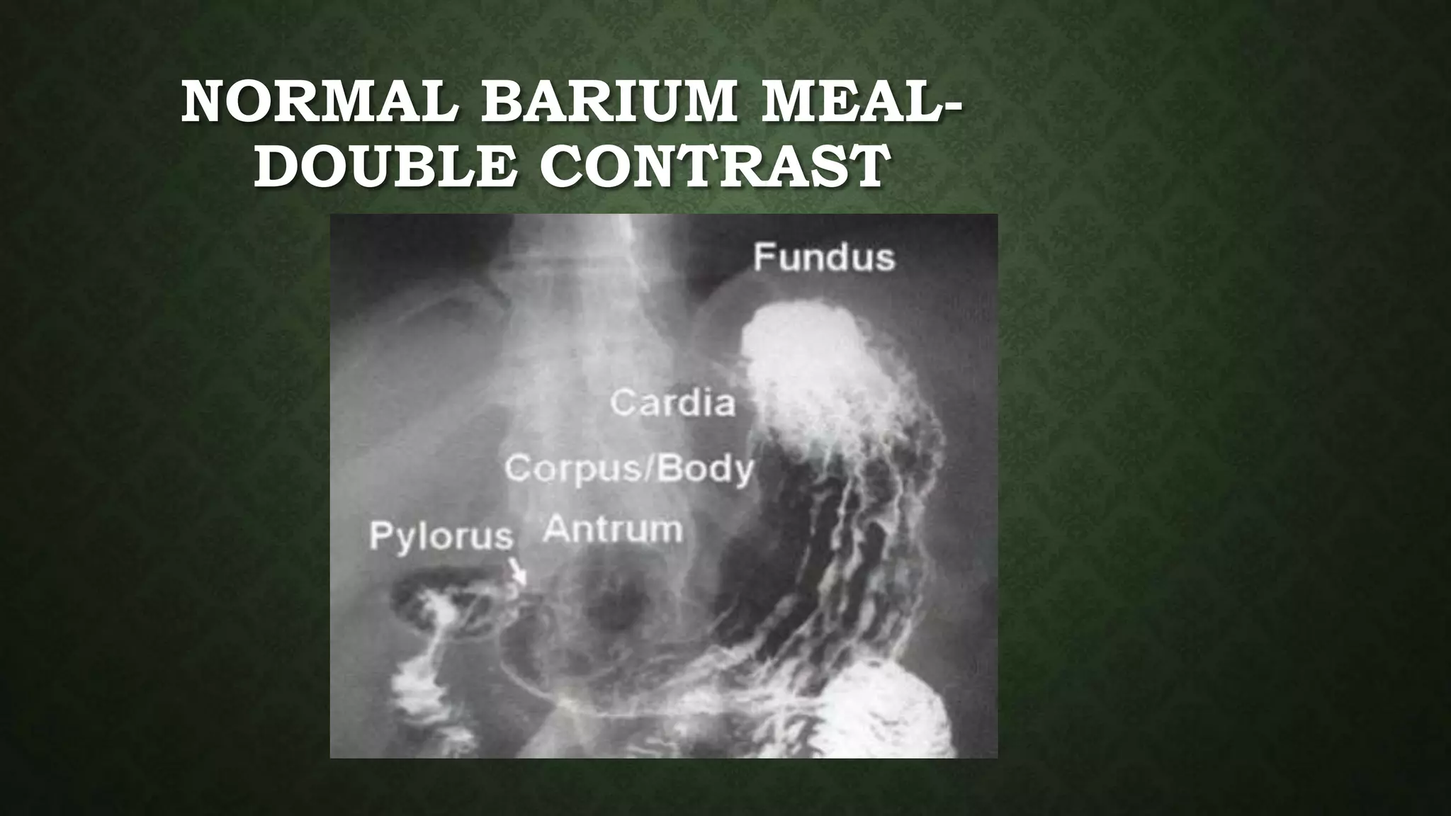 barium meal .pptx