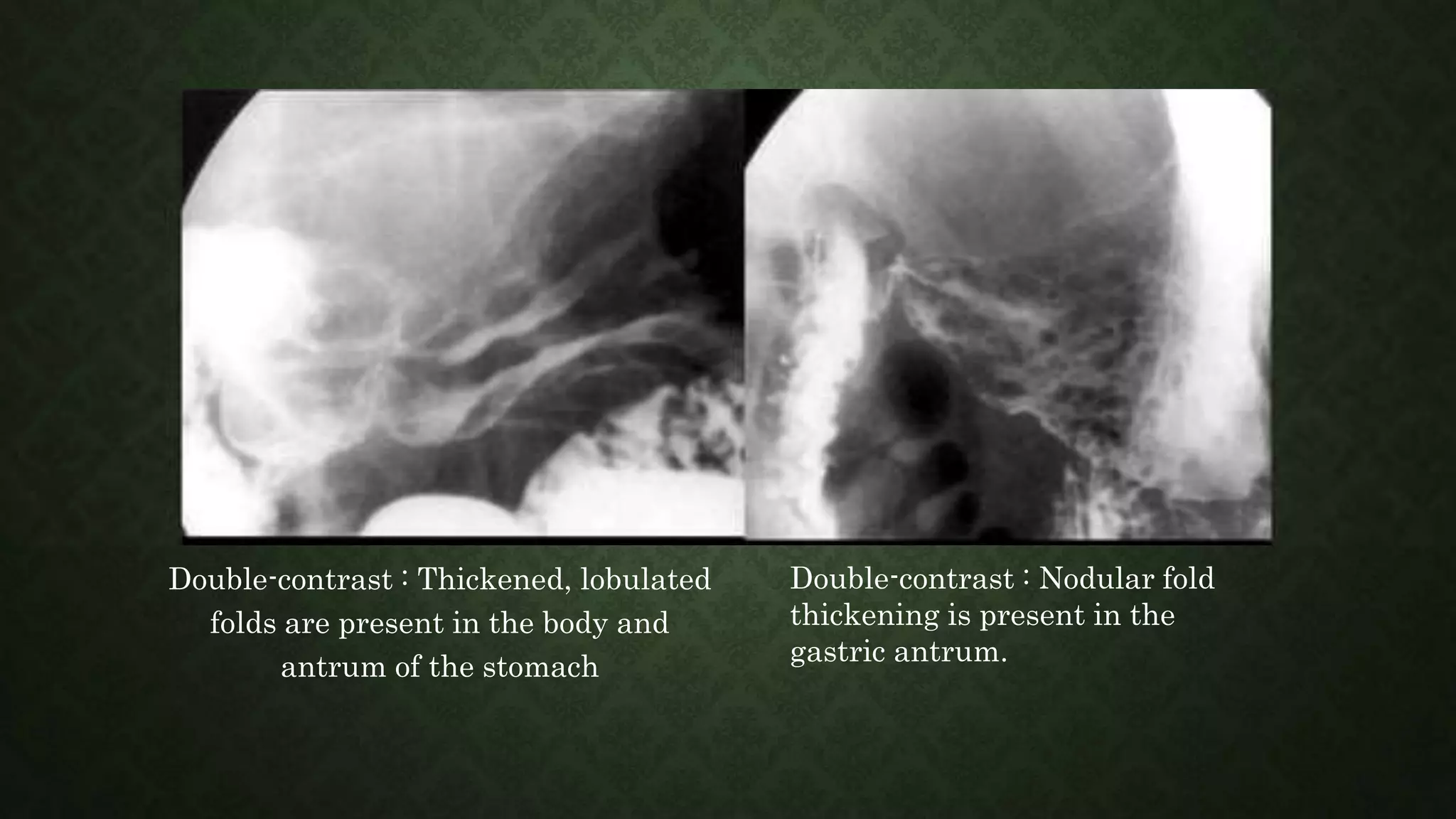 barium meal .pptx