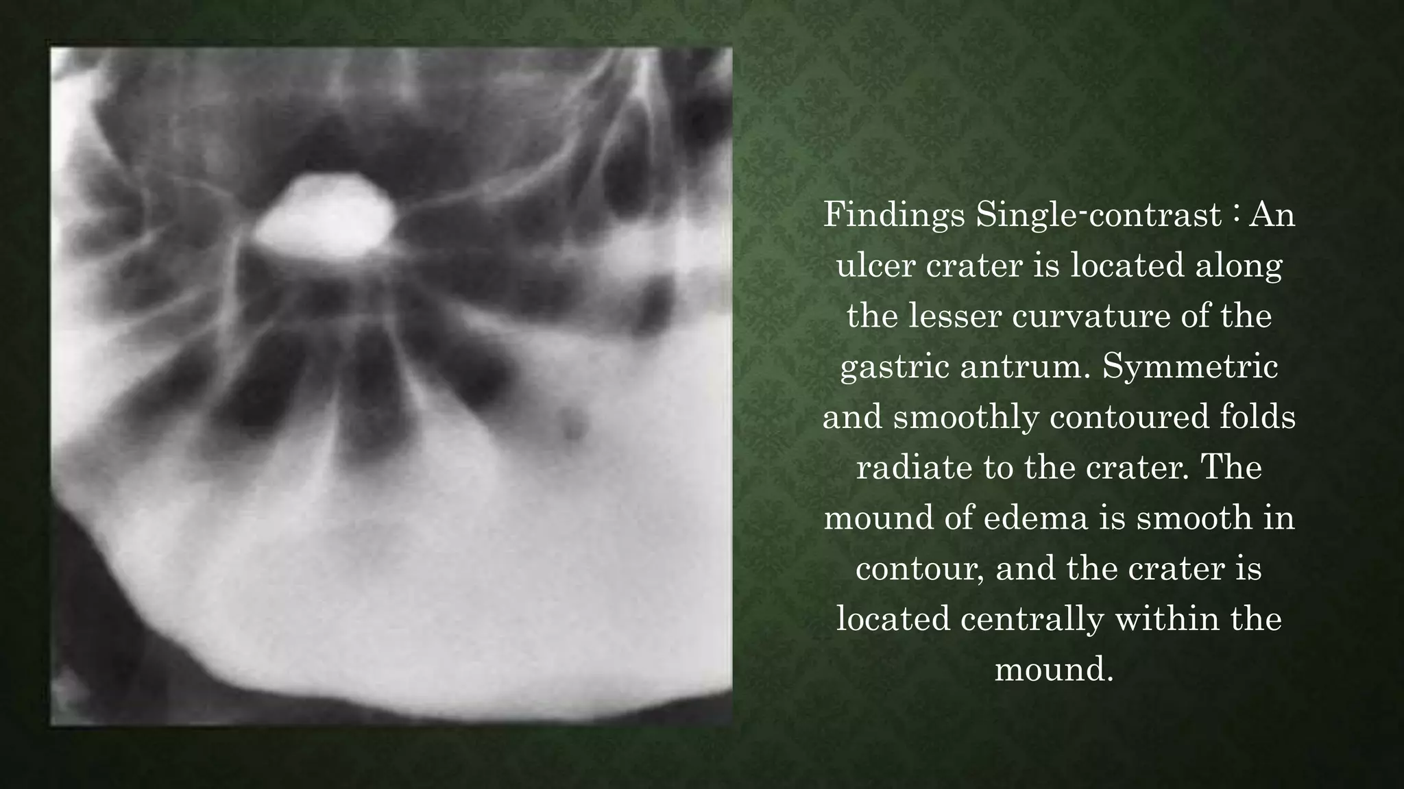 barium meal .pptx