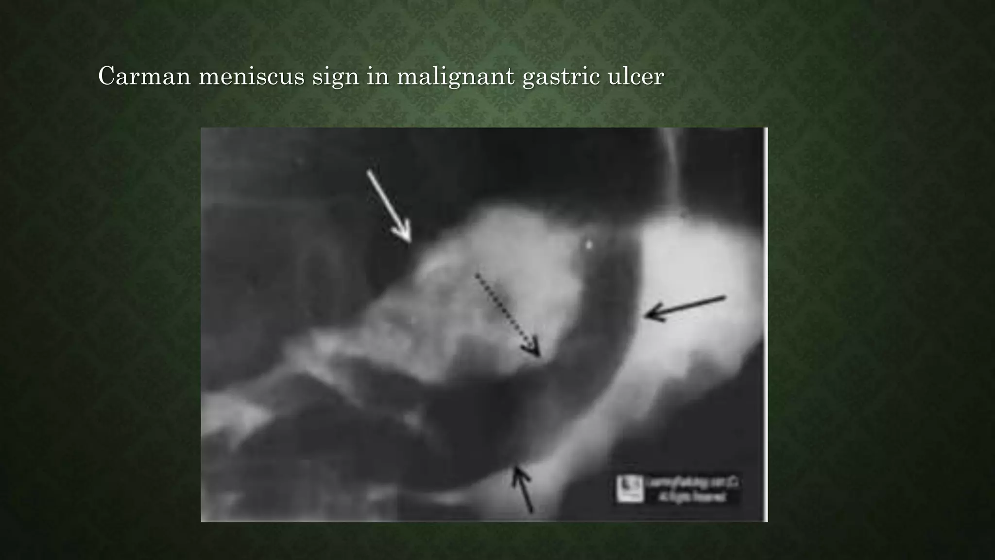 barium meal .pptx