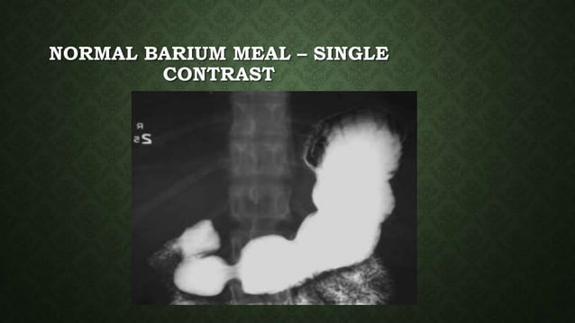 barium meal .pptx