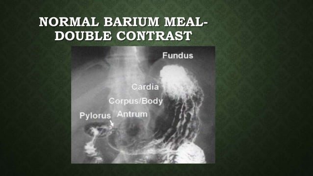 barium meal .pptx