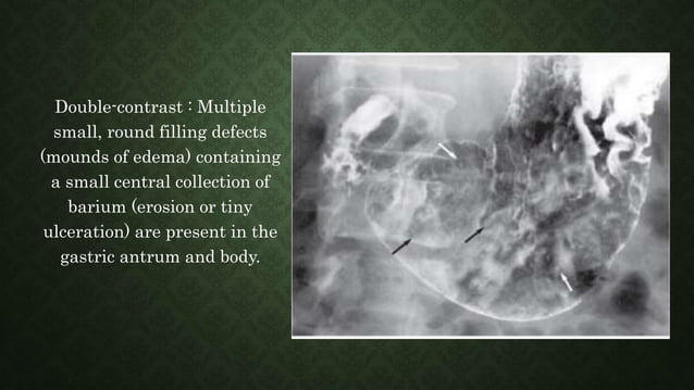 barium meal .pptx