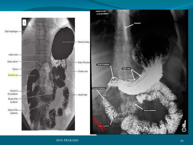 Barium meal follow through | PPTX