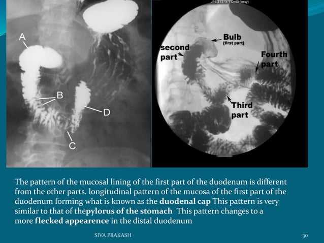Barium meal follow through | PPTX
