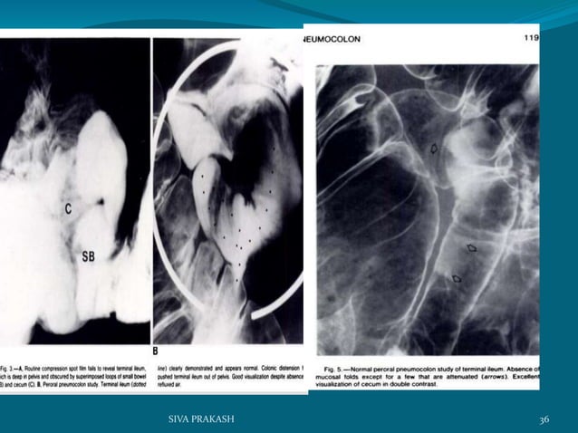 Barium meal follow through | PPTX