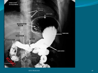 Normal Barium Swallow Anatomy