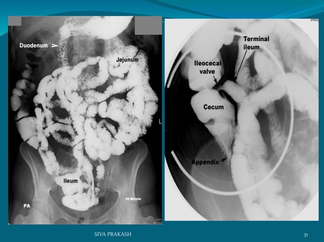 Barium meal follow through | PPT