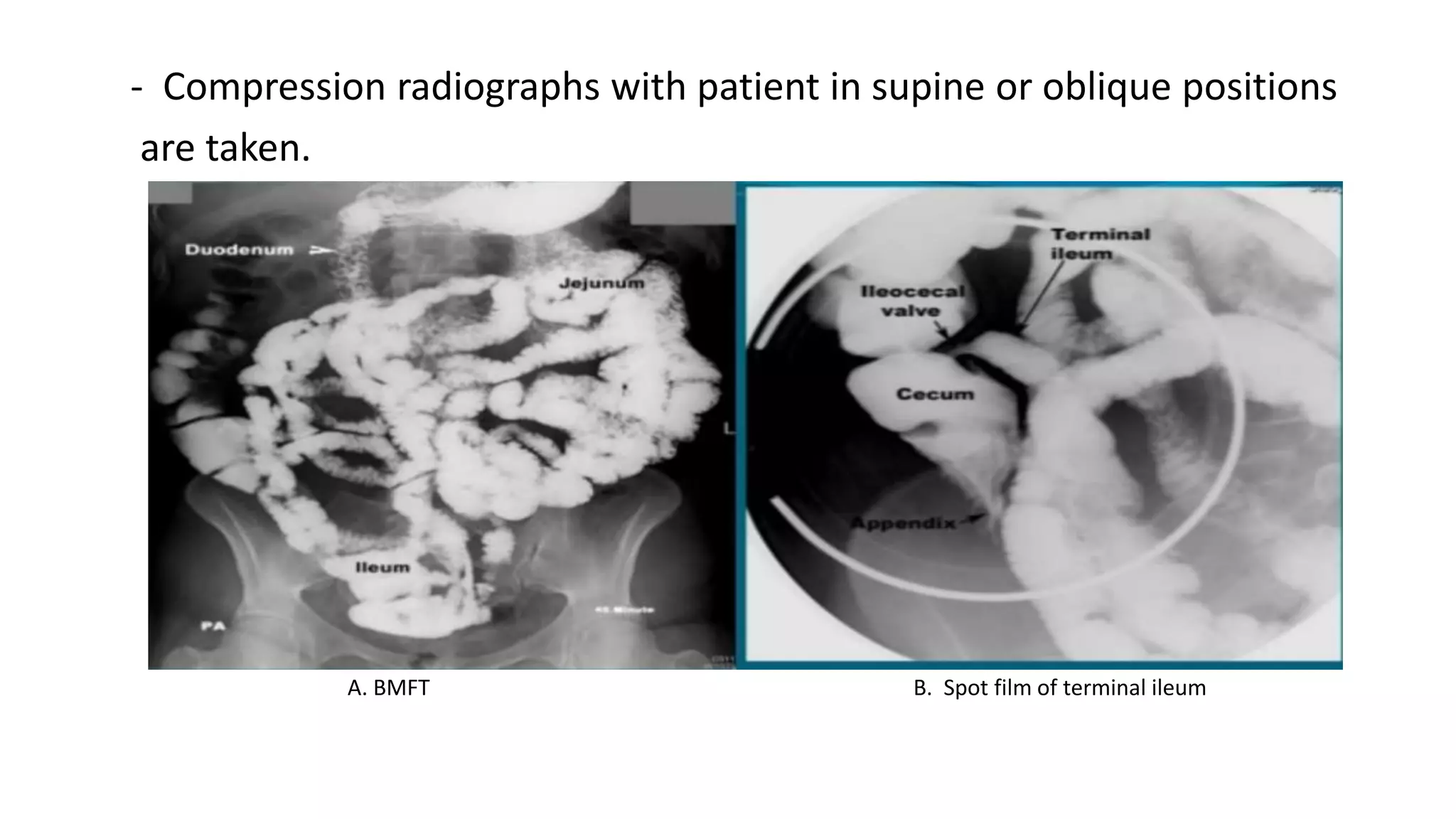 Barium meal follow through (BMFT), Enteroclysis and Barium enema (BE ...
