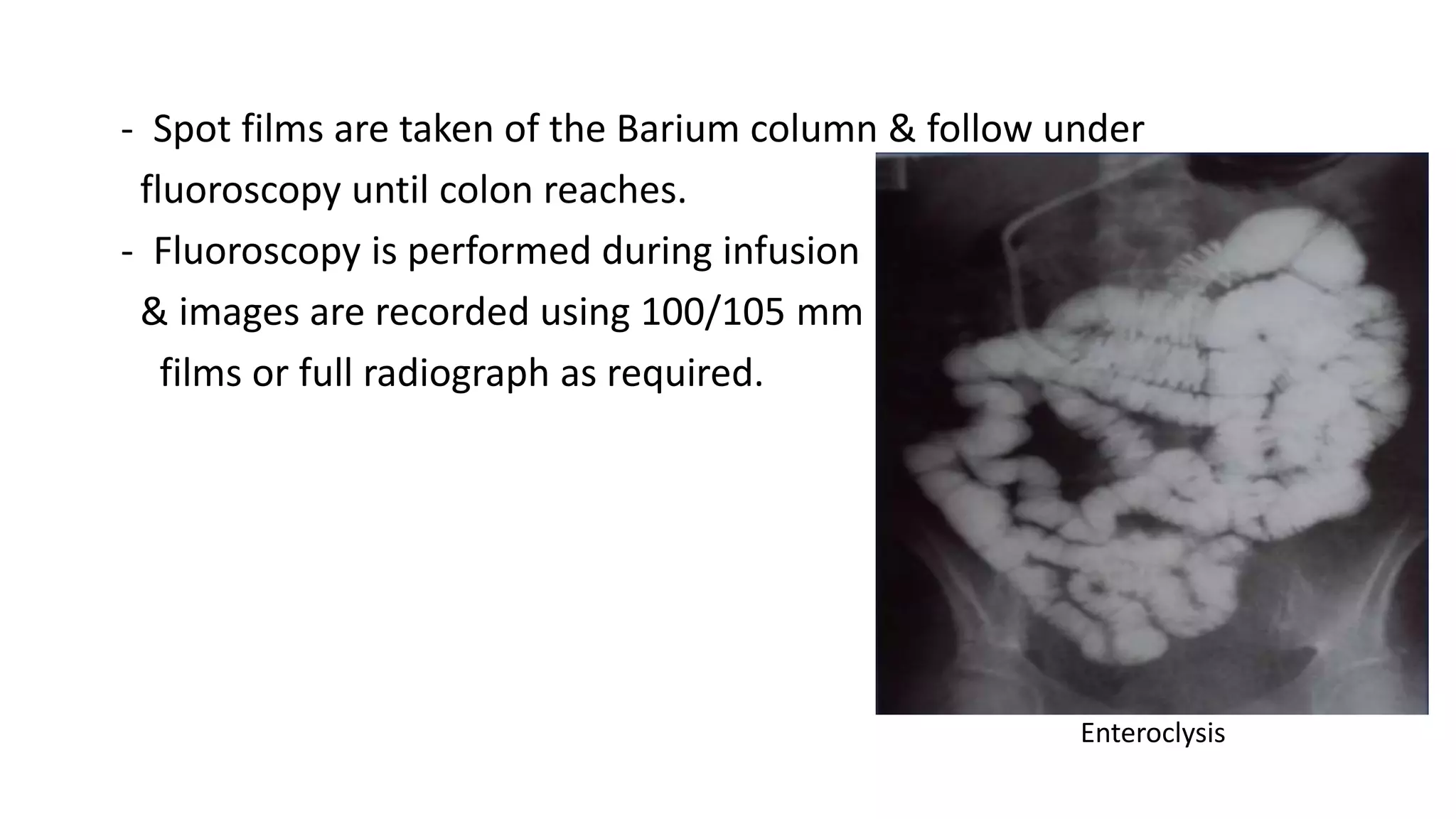 Barium meal follow through (BMFT), Enteroclysis and Barium enema (BE ...