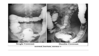 Barium meal follow through (BMFT), Enteroclysis and Barium enema (BE ...