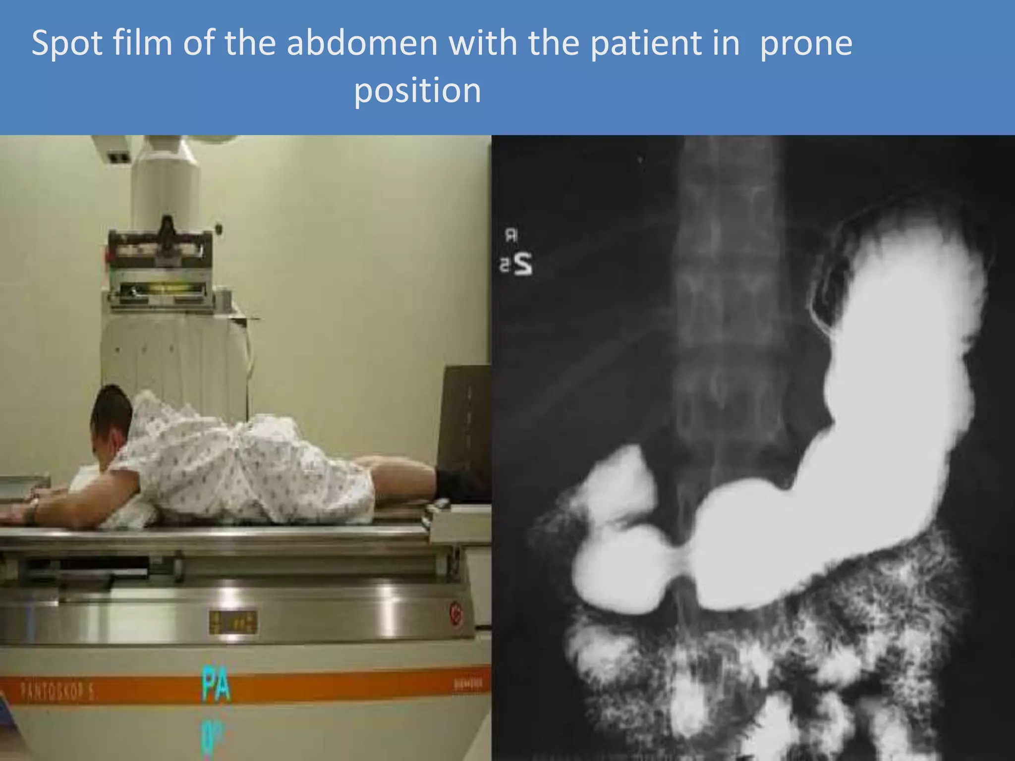 Barium procedures | PPTX | Digestive Disorders | Diseases and Conditions