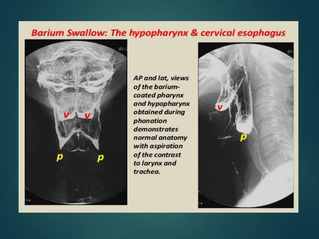 Barium procedures | PPTX | Digestive Disorders | Diseases and Conditions