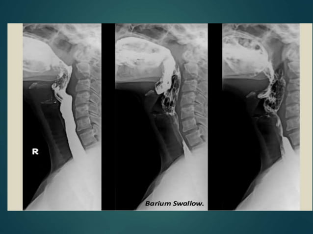 Barium procedures | PPTX | Digestive Disorders | Diseases and Conditions
