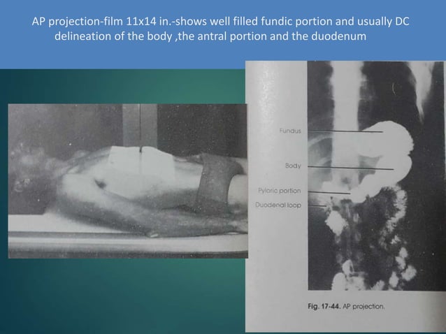 Barium procedures | PPTX | Digestive Disorders | Diseases and Conditions