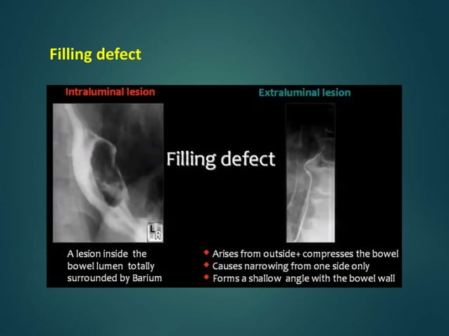 Barium procedures | PPTX | Digestive Disorders | Diseases and Conditions