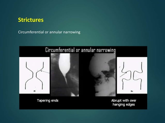 Barium procedures | PPTX | Digestive Disorders | Diseases and Conditions