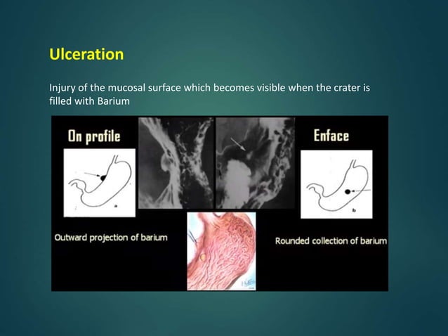 Barium procedures | PPTX | Digestive Disorders | Diseases and Conditions