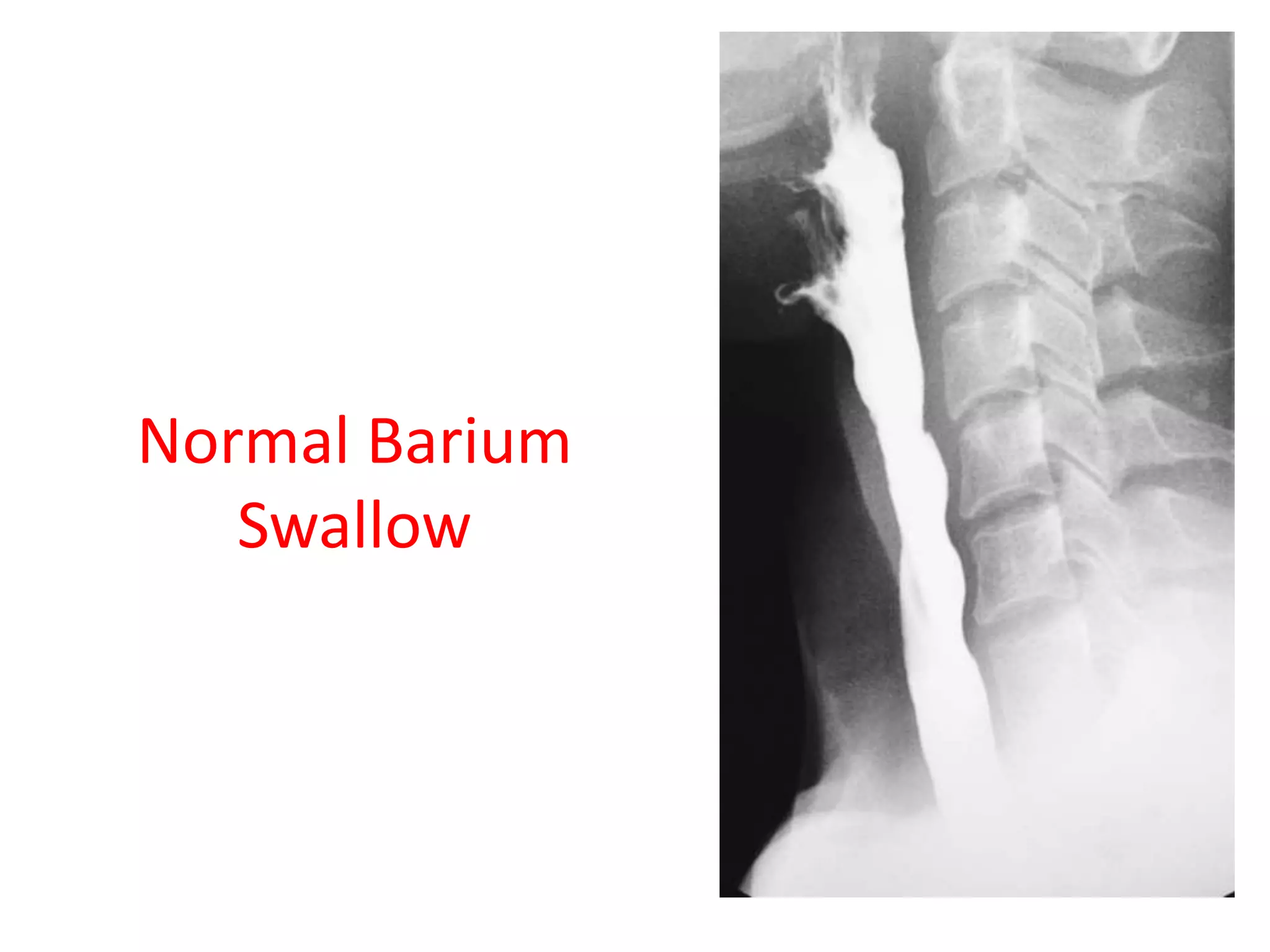 Barium studies | PPTX