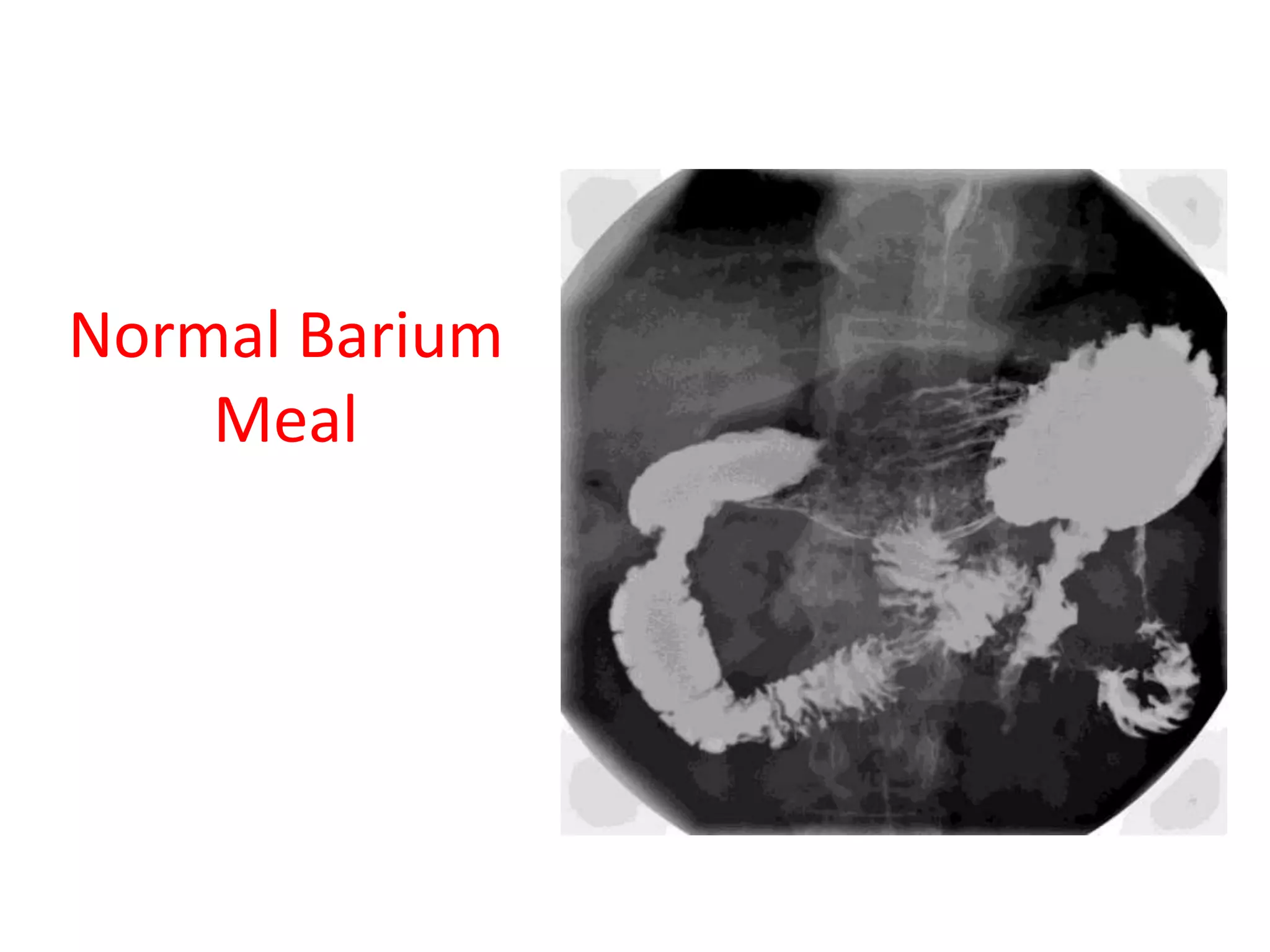 Barium studies | PPTX