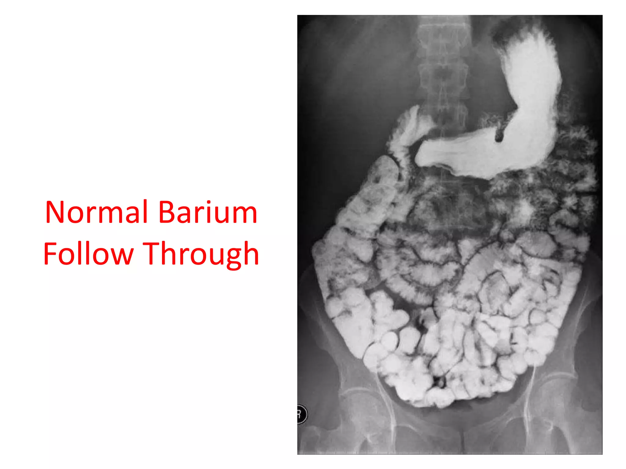 Barium studies | PPTX